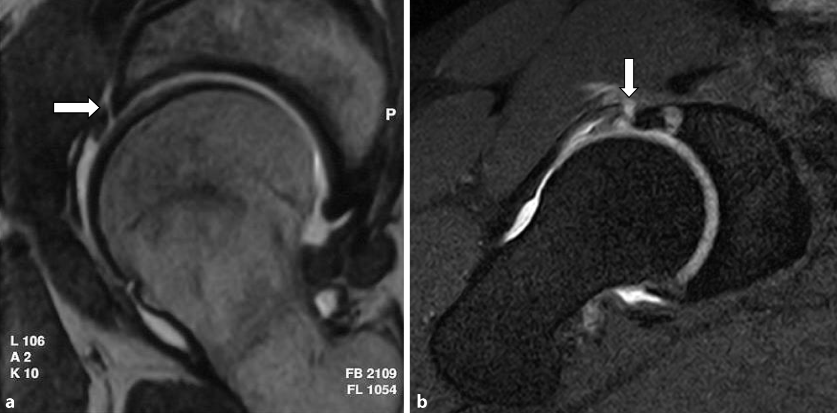 Labrumpathologie des Hüftgelenkes | SpringerLink