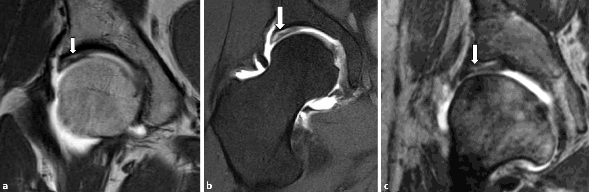 Labrumpathologie des Hüftgelenkes | SpringerLink