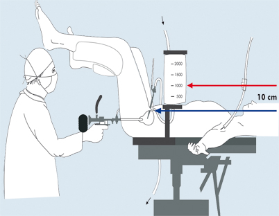 Die radikale transurethrale Resektion der Prostata | SpringerLink