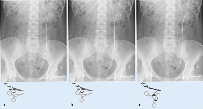 Die Duplex-Doppel-J-Schiene bei intrinsischen und extrinsischen ...