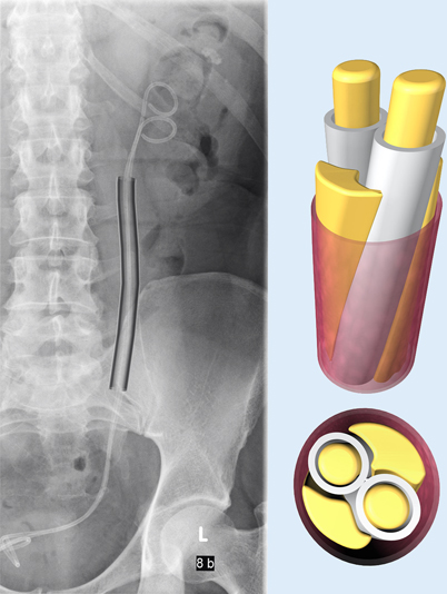Die Duplex-Doppel-J-Schiene bei intrinsischen und extrinsischen ...