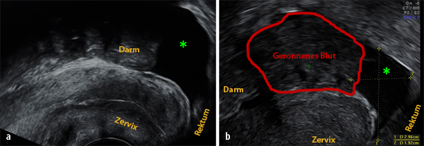 Sonographie in der Gynäkologie | SpringerLink