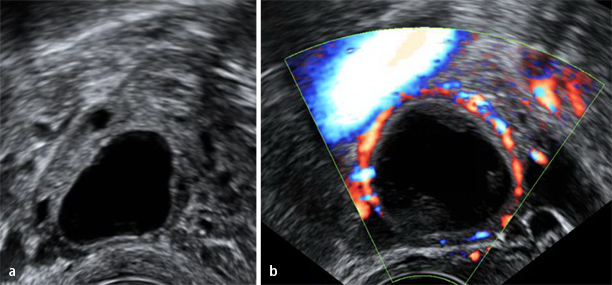 Sonographie in der Gynäkologie | SpringerLink
