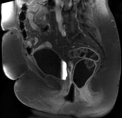 Abdominale Hysterektomie | SpringerLink