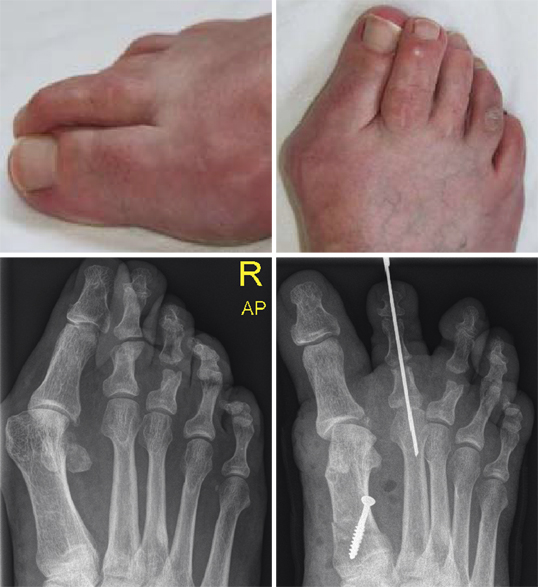 Rezidive nach Korrektur von Hammer- und Krallenzehen | SpringerLink