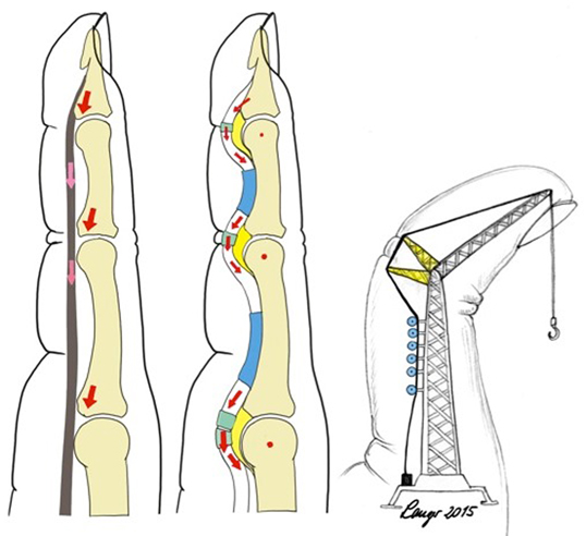 Ringbandrekonstruktion an der Hand | SpringerLink