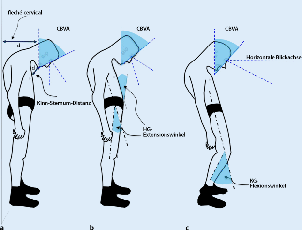 Die fixierte zervikale hochgradige Kyphose | SpringerLink