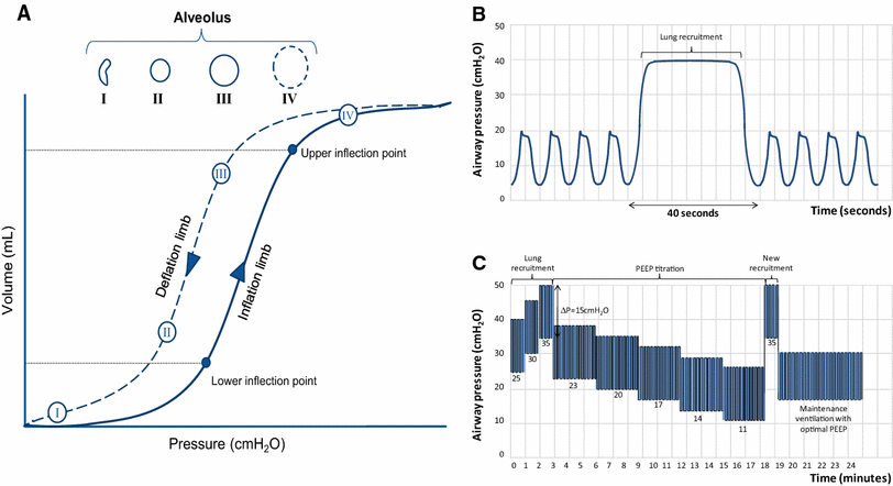 Understanding recruitment maneuvers | SpringerLink