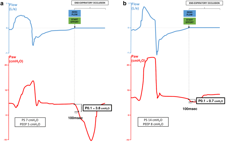 The airway occlusion pressure ( P0.1) to monitor respiratory drive ...