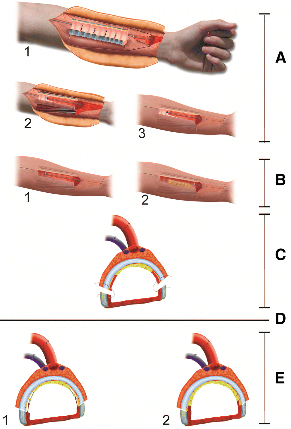 Tracheal transplantation | SpringerLink