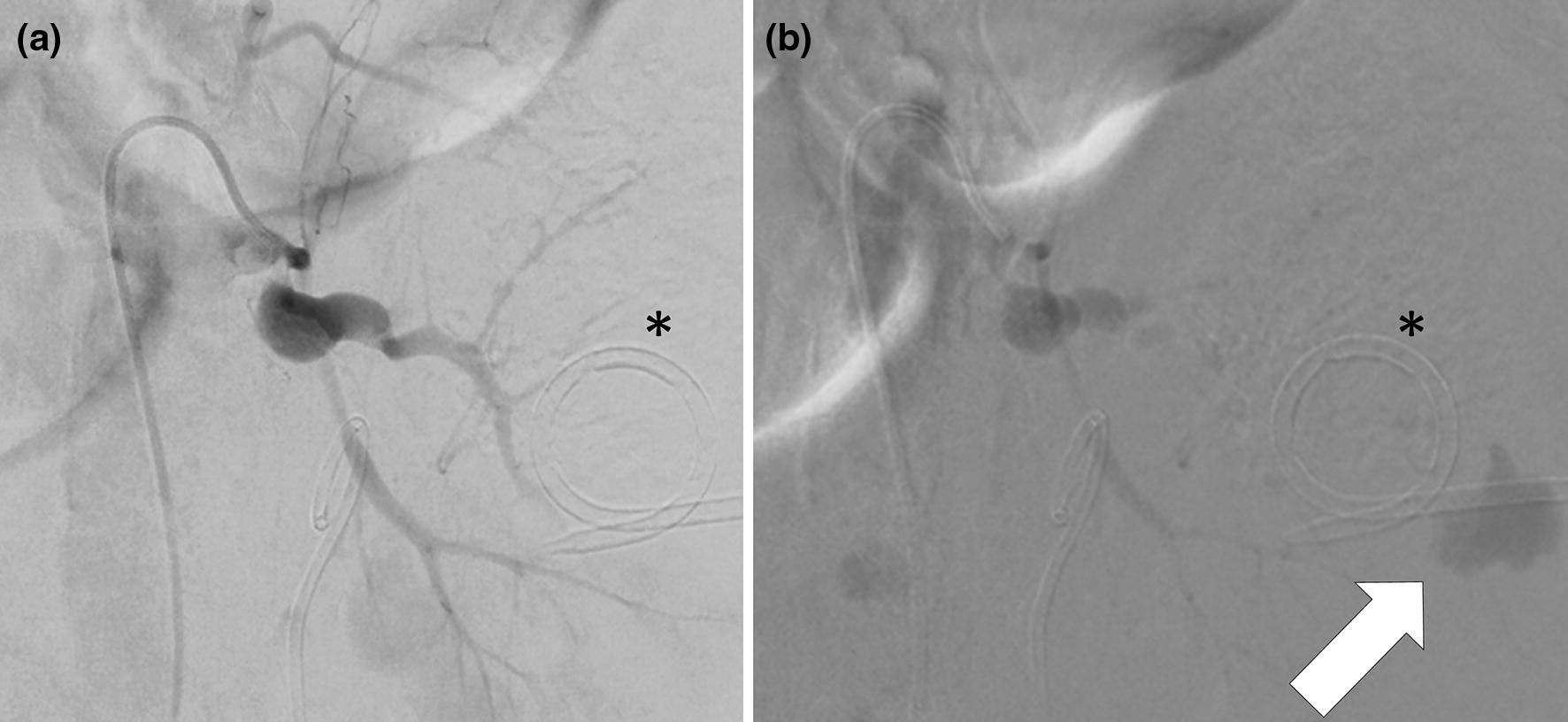 Carbon dioxide angiography for detecting minor hemorrhage | SpringerLink
