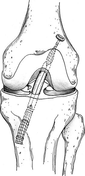 Anatomic double bundle ACL reconstruction: a literature review ...