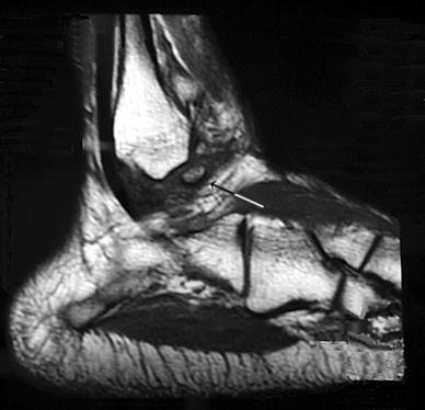 True submalleolar accessory ossicles causing impingement of the ankle ...