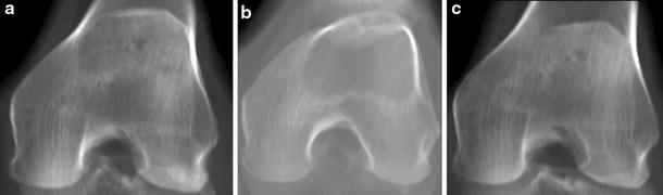 Assessment of correlation between knee notch width index and the three ...