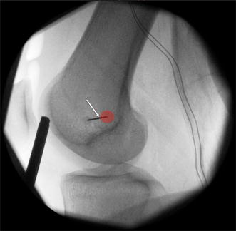 MRI but not arthroscopy accurately diagnoses femoral MPFL injury in ...