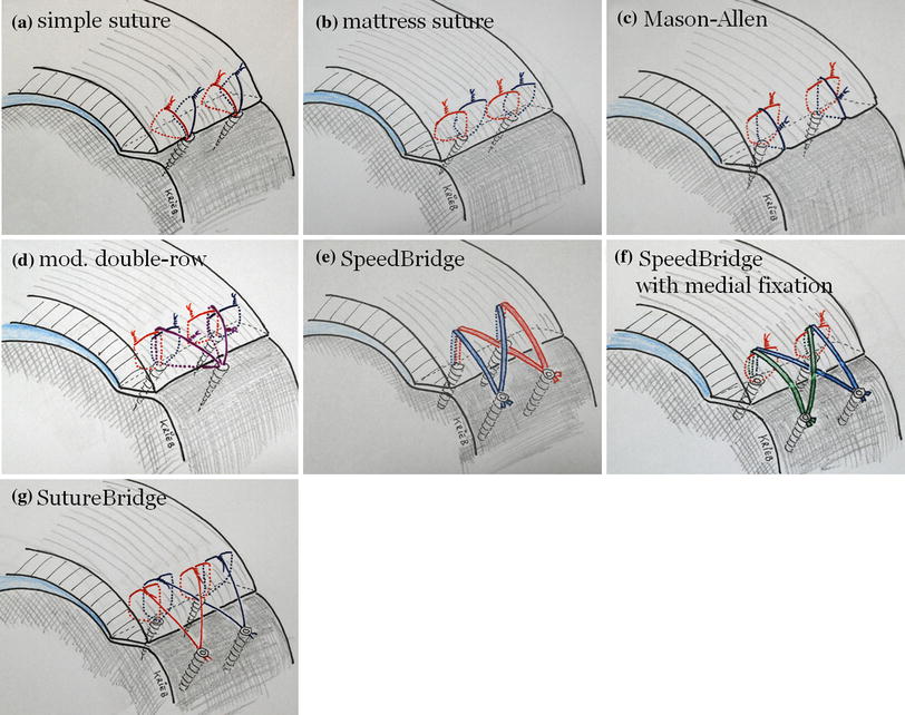 Superiority of bridging techniques with medial fixation on initial ...