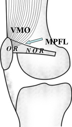 Non-surgical treatment for acute patellar dislocation with special ...