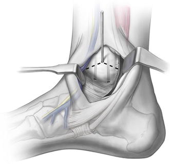 Chevron-type medial malleolar osteotomy: a functional, radiographic and ...