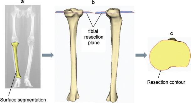 Anatomic tibial component design can increase tibial coverage and ...