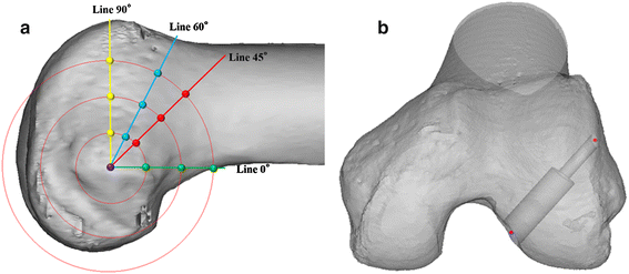 Optimal entry position on the lateral femoral surface for outside-in ...