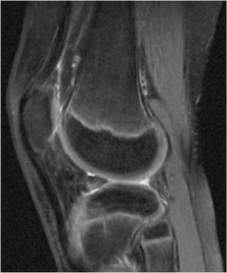 The hypermobile lateral meniscus: a retrospective review of ...