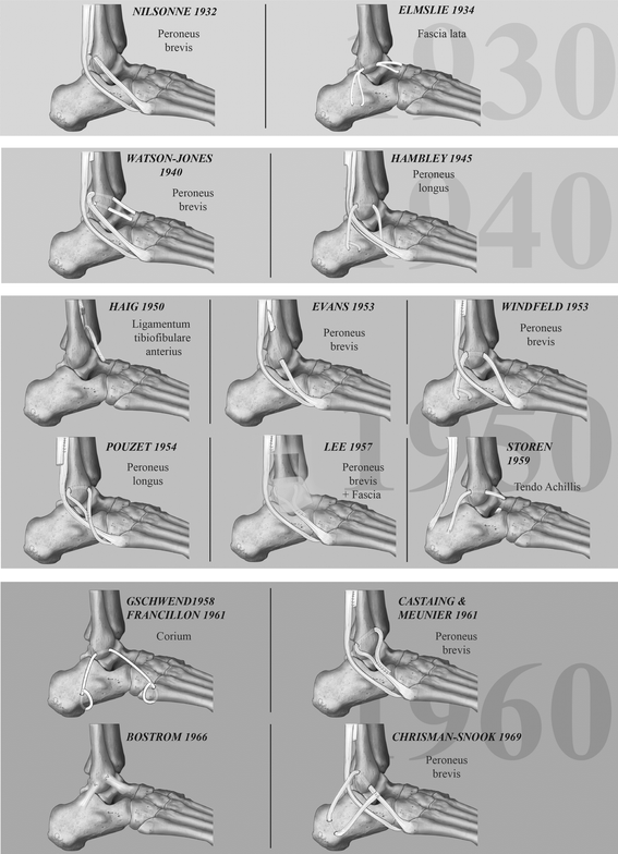 A historical perspective on ankle ligaments reconstructive surgery ...