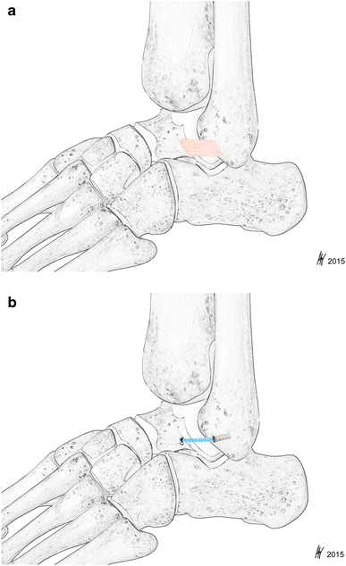 Biomechanical stability of tape augmentation for anterior talofibular ...