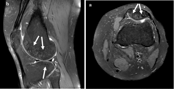 Bone marrow lesions and subchondral bone pathology of the knee ...