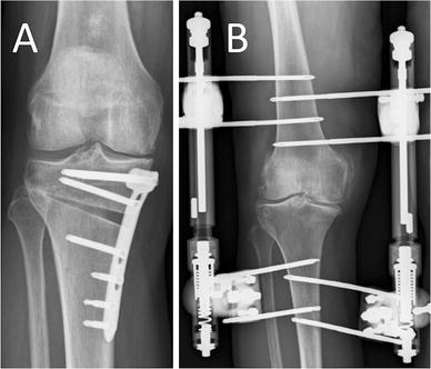 Knee joint distraction compared with high tibial osteotomy: a ...