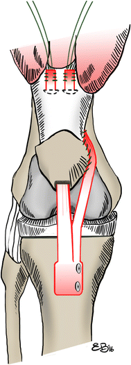 Surgical options for chronic patellar tendon rupture in total knee ...