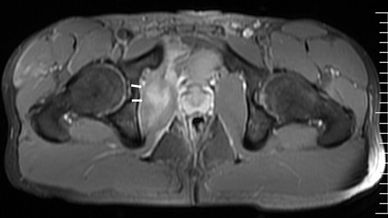 Injuries of the obturator muscles in professional soccer players ...