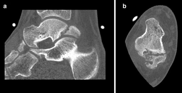 Talus bipartitus: a systematic review and report of two cases with ...