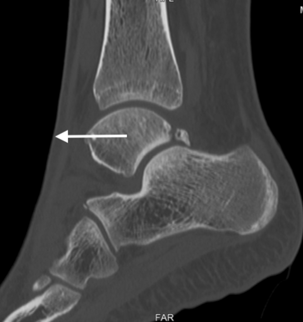 Chronic lateral ankle instability increases the likelihood for surgery ...