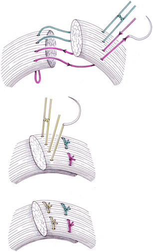 Guidelines for the management of third and fourth degree perineal tears ...