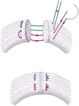 Guidelines for the management of third and fourth degree perineal tears ...