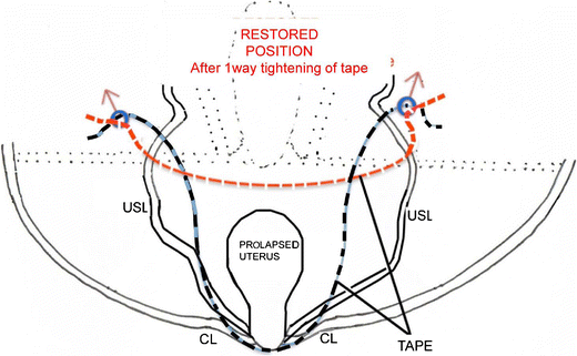 Reinforcement of suspensory ligaments under local anesthesia cures ...