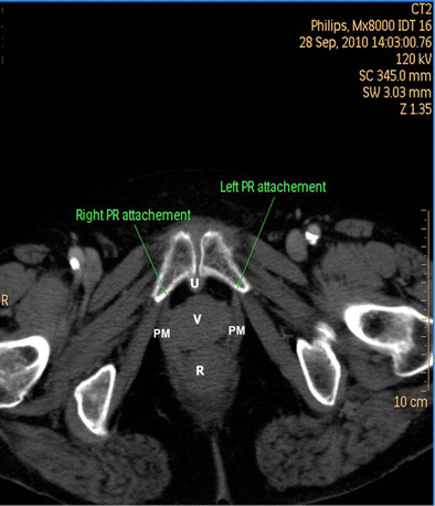 Erratum to: An International Urogynecological Association (IUGA ...