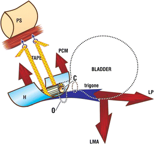 Outpatient mid-urethral tissue fixation system sling for urodynamic ...