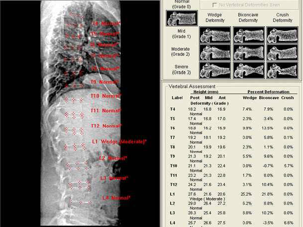Combined vertebral fracture assessment and bone mineral density ...