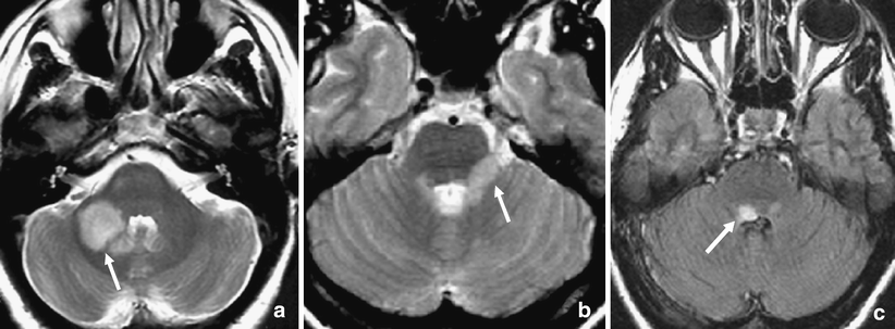 Idiopathic inflammatory-demyelinating diseases of the central nervous system | SpringerLink