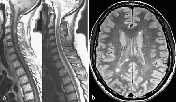 Idiopathic inflammatory-demyelinating diseases of the central nervous system | SpringerLink