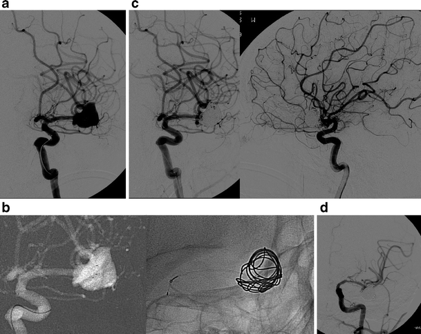 Waffle-cone technique with Solitaire™ AB Remodeling Device ...