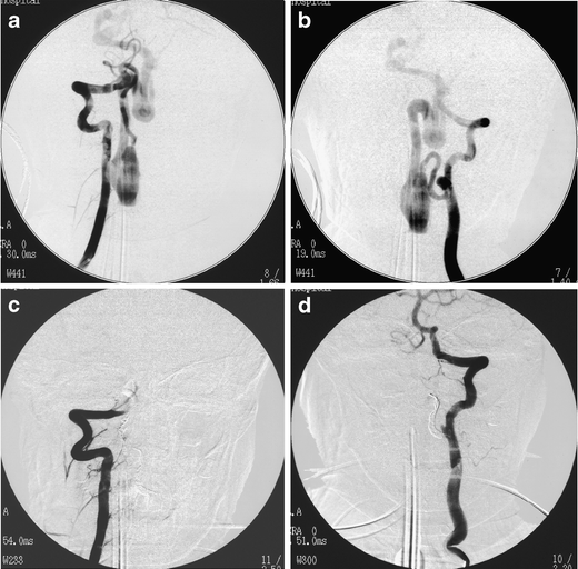 Endovascular embolization for symptomatic perimedullary AVF and ...
