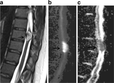 Diffusion-weighted MR imaging (DWI) in two intradural spinal epidermoid ...