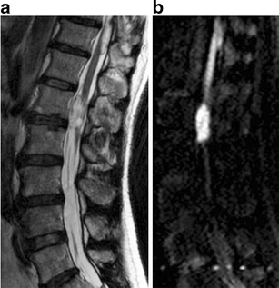 Diffusion-weighted MR imaging (DWI) in two intradural spinal epidermoid ...