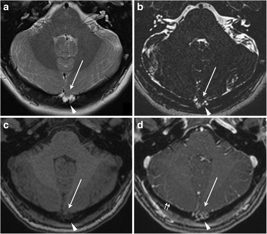 Brain herniations into arachnoid granulations: about 68 cases in 38 ...