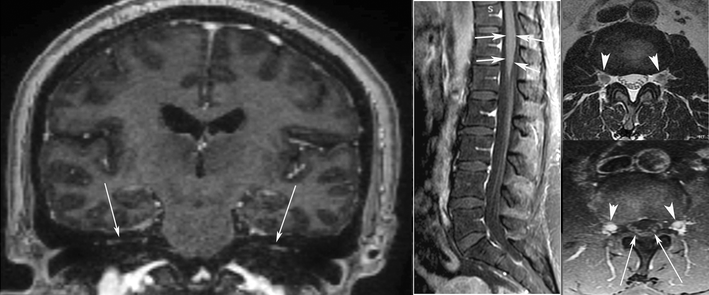 Magnetic resonance imaging findings in Guillain-Barré syndrome caused ...