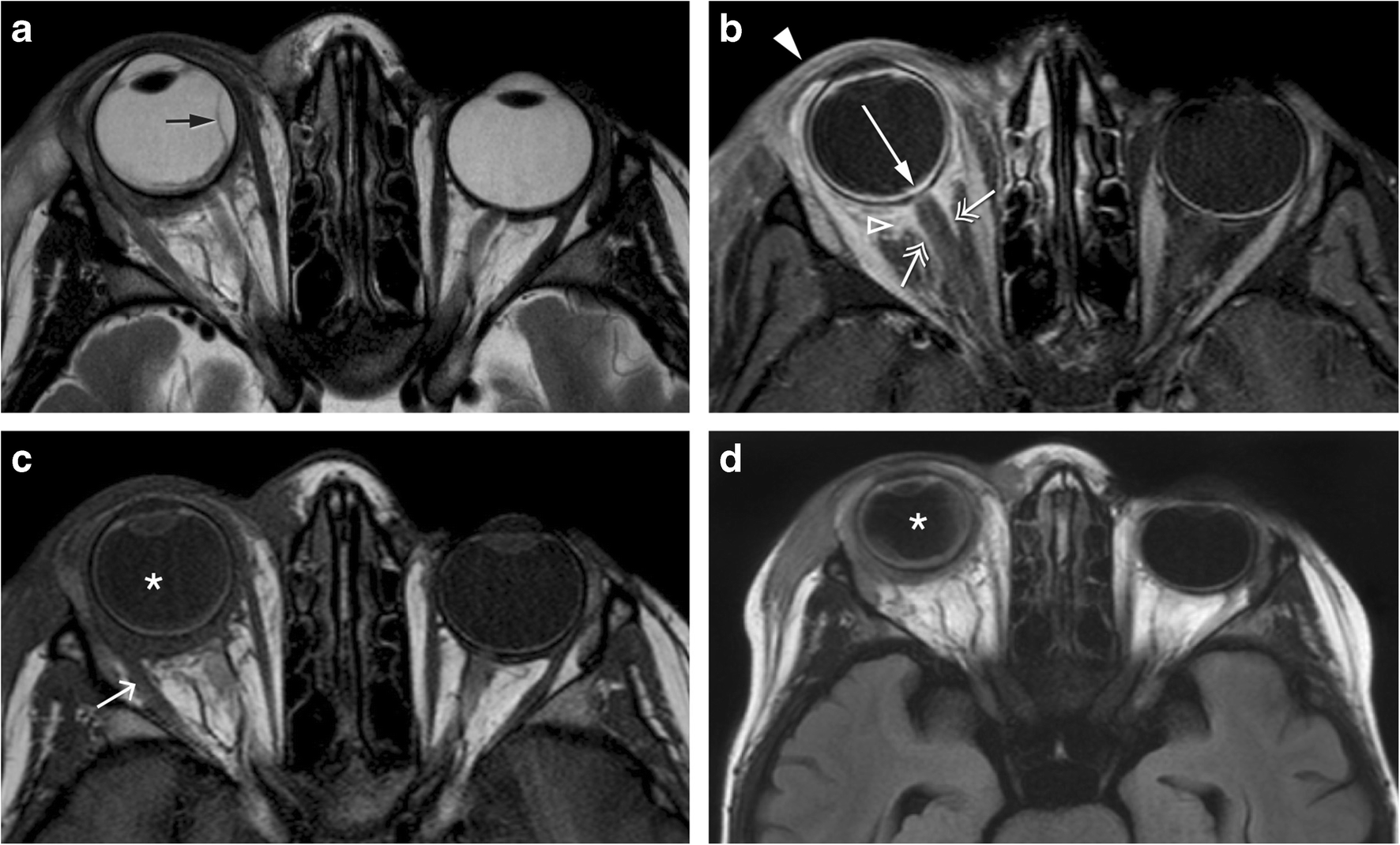 CT and MR imaging of orbital inflammation | SpringerLink