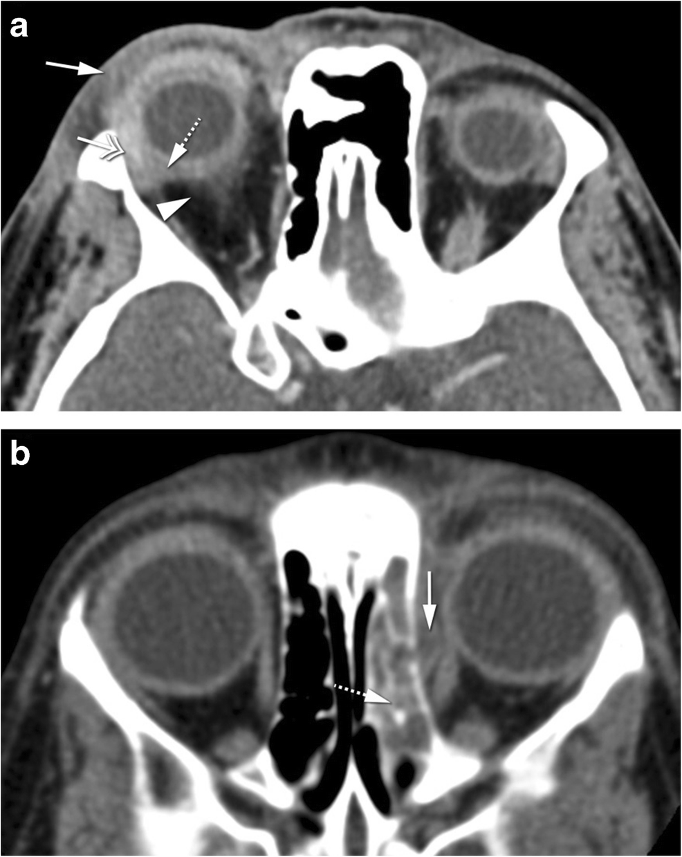 CT and MR imaging of orbital inflammation | SpringerLink