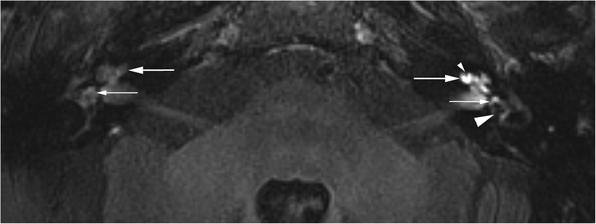 The value of four stage vestibular hydrops grading and asymmetric ...